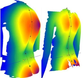 Scoliosis Treatment, Spinecor Brace, Schroth Exercises Plus