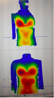 Asymmetry of the Ribs - Scoli-Fit | Non-surgical Scoliosis Treatment by ...